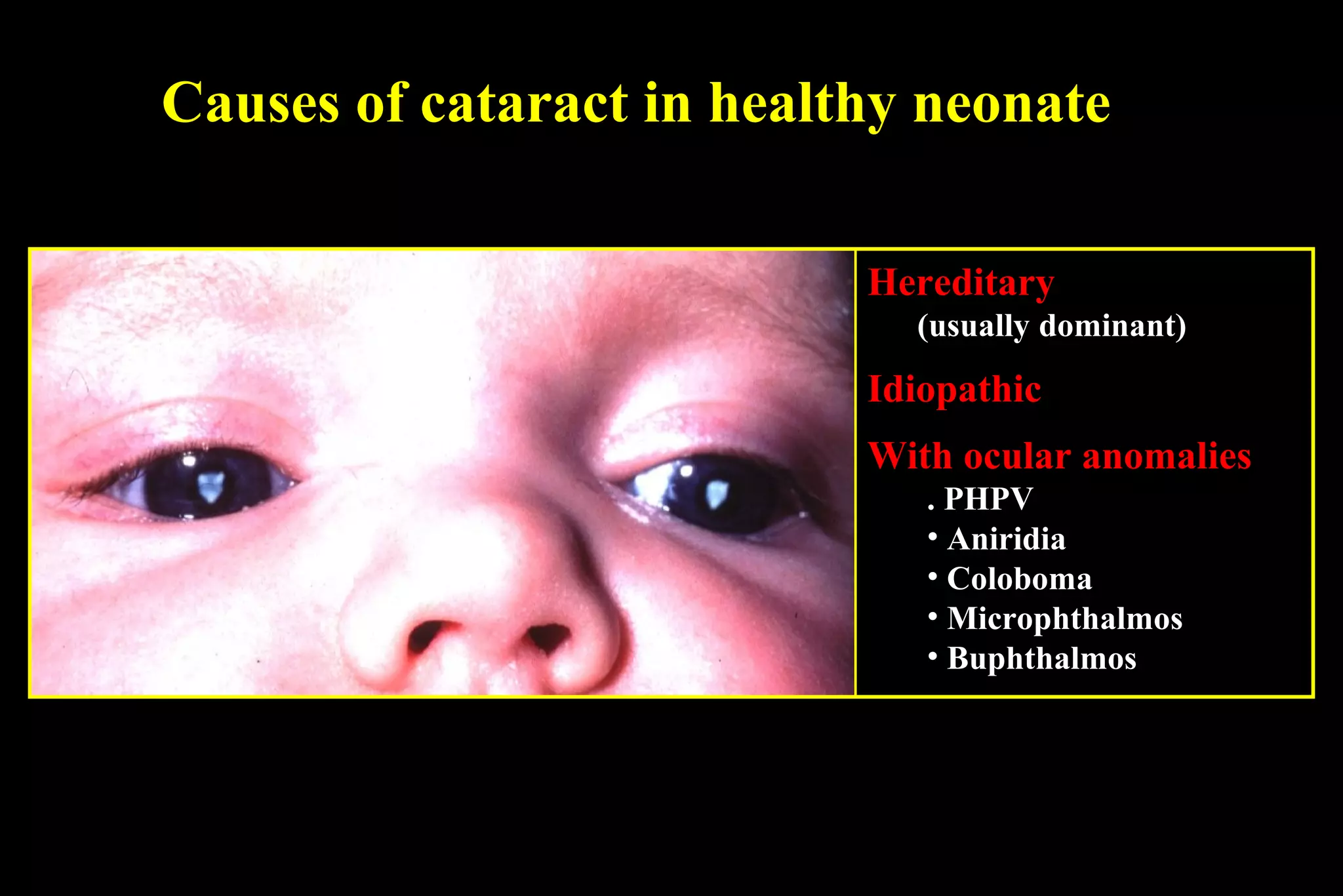 23 congenital cataract | PPT