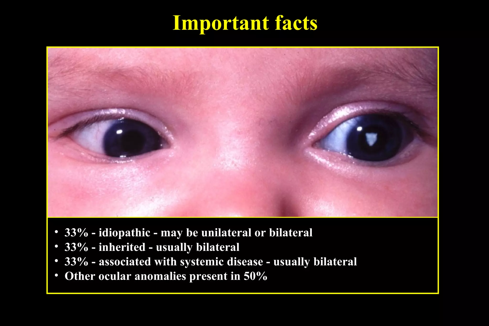 23 congenital cataract | PPT