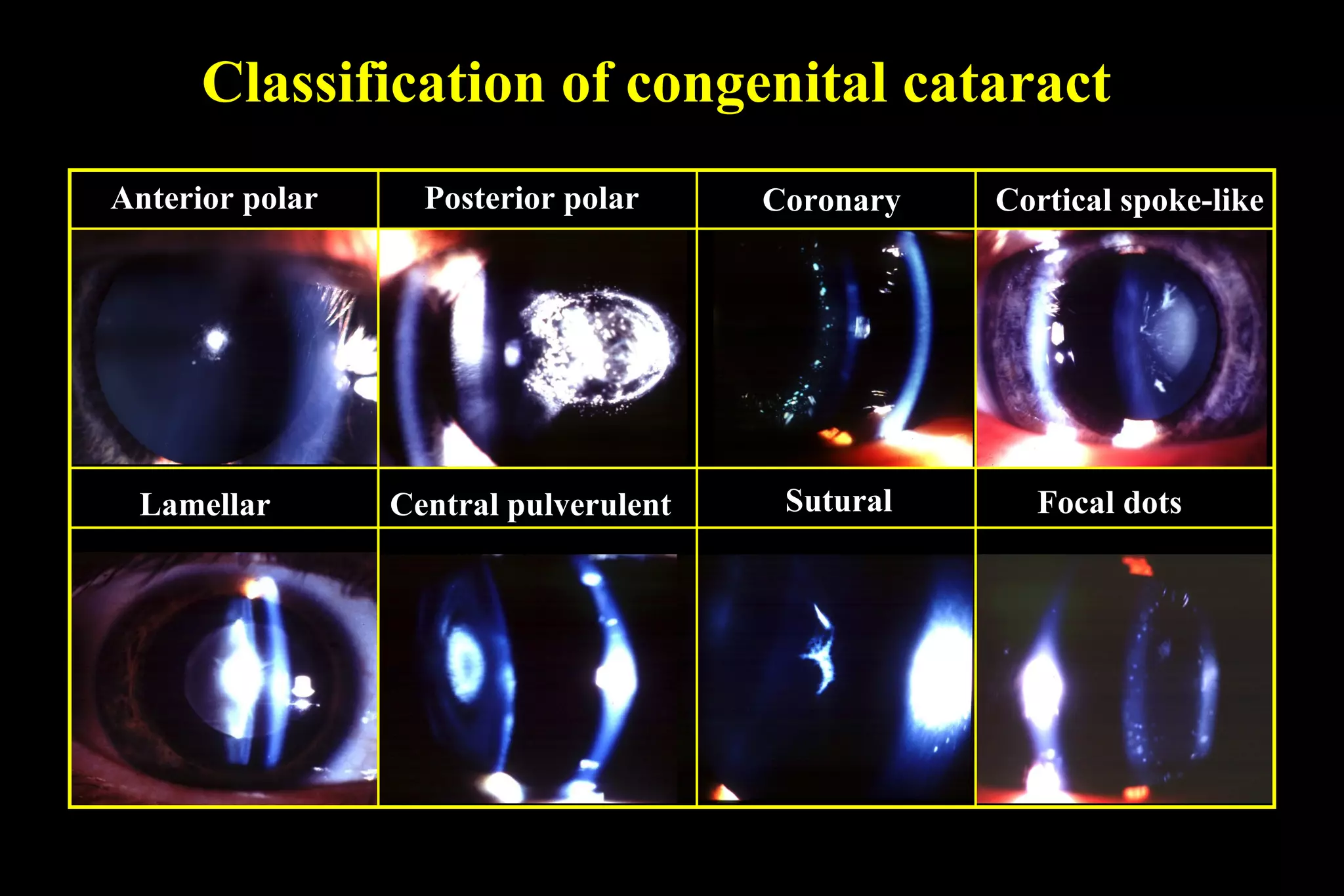 23 congenital cataract | PPT