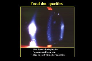 23 congenital cataract | PPT