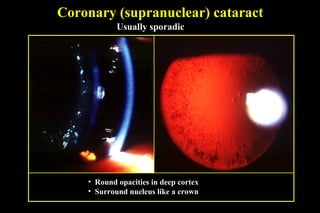 23 congenital cataract | PPT