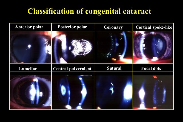 23 congenital cataract