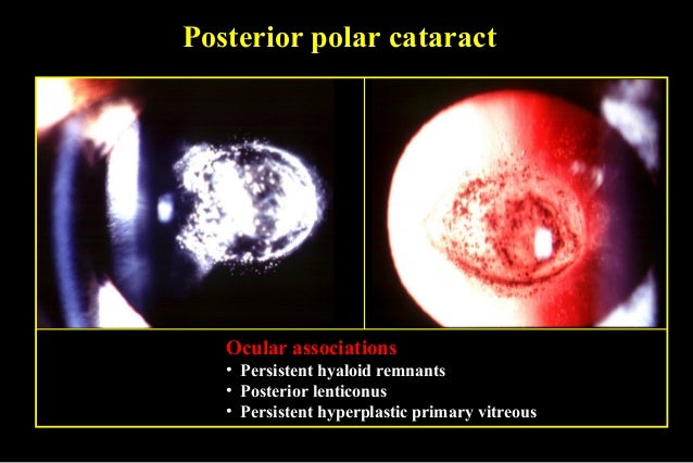 23 Congenital Cataract