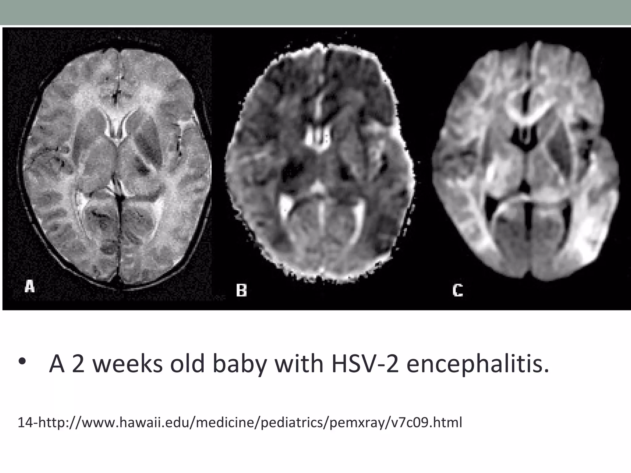 Hsv encephalitis final | PPT