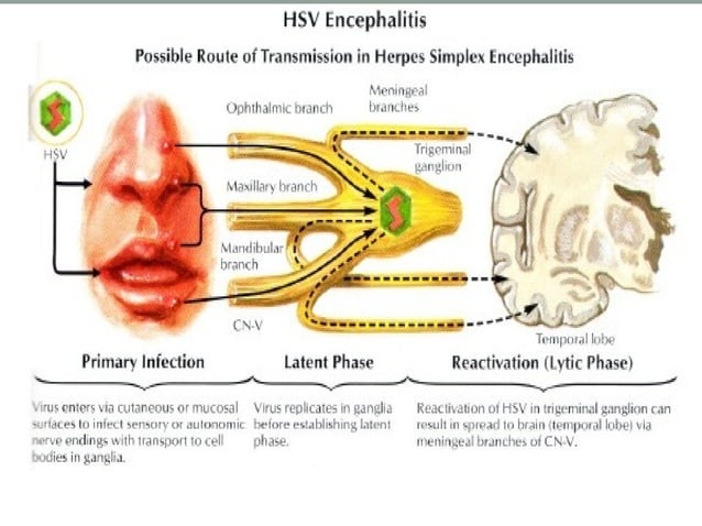 Hsv encephalitis final | PPT