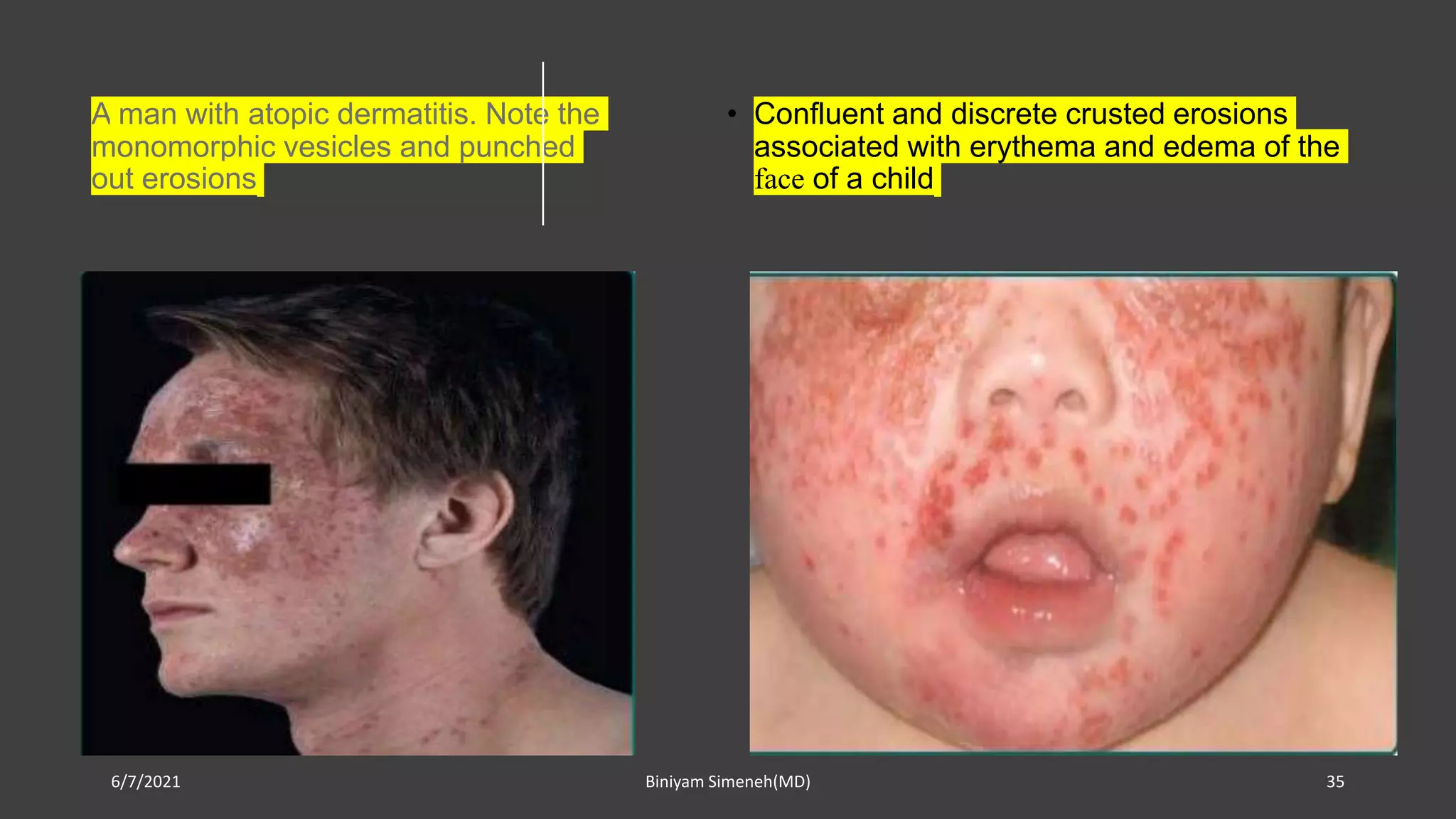 Hsv infections(cutaneous and genital)