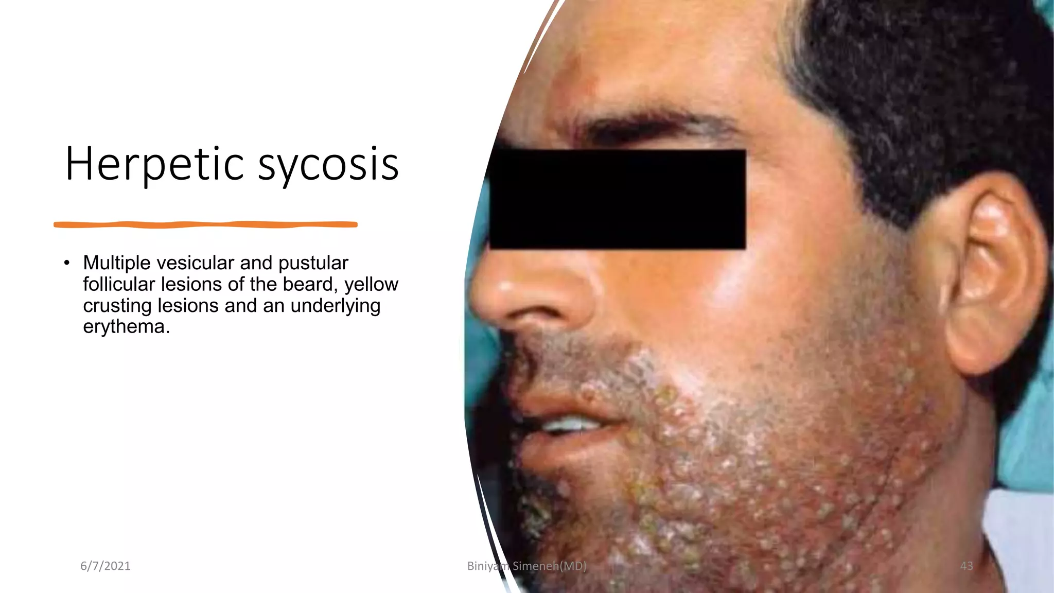 Hsv infections(cutaneous and genital)