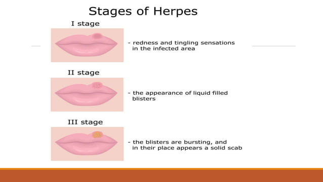 HERPES SIMPLEX VIRUS INFECTIONS PPT.pptx | Infectious Diseases ...