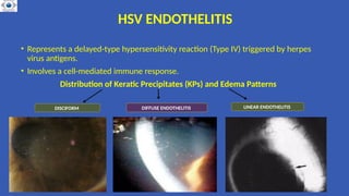 HSV KERATITIS . CLINICAL FEATURES , TYPES , DIAGNOSIS , TREATMENT ...