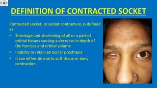 CONTRACTED_SOCKET presentation DHB .pptx