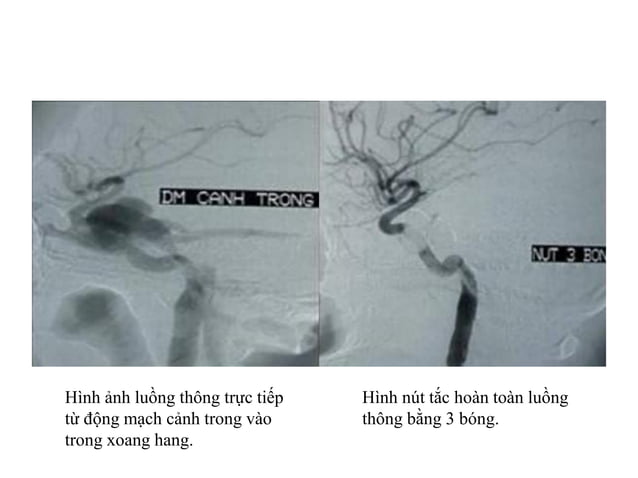 HT CHẨN ĐOÁN DÒ ĐỘNG MẠCH XOANG HANG.pdf