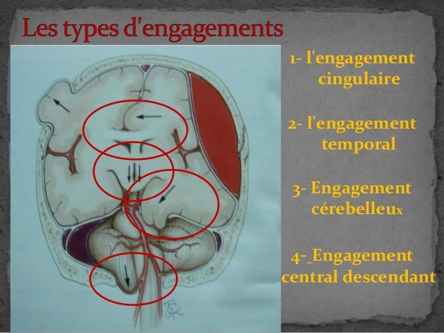 HTIC - Hypertension intracrânienne