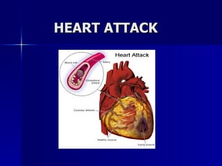 hypertension and diabetes - risk factors for Myocardial infarction | PPT