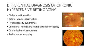 Hypertensive Retinopathy | PPTX