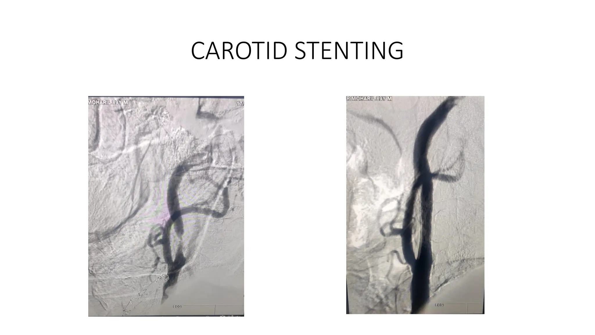 HYPERTENSION - CASE BASED DISCUSSION.pptx