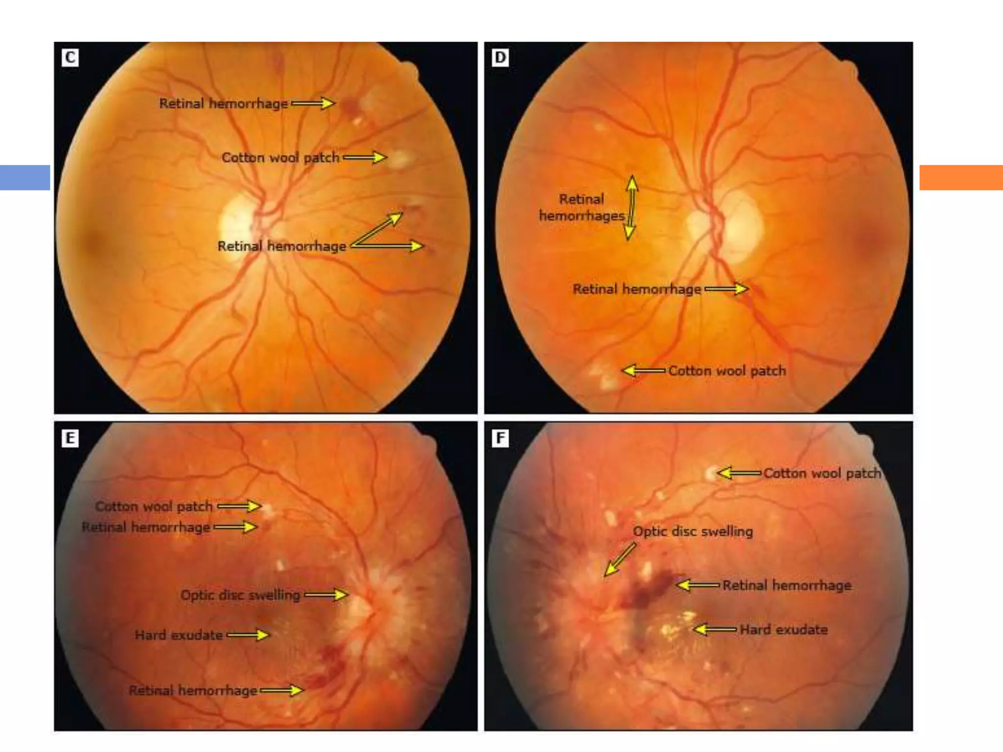 HYPERTENSIVE RETINOPATHY.pptx