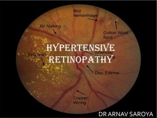 HYPERTENSIVE RETINOPATHY - DR ARNAV SAROYA | PPT