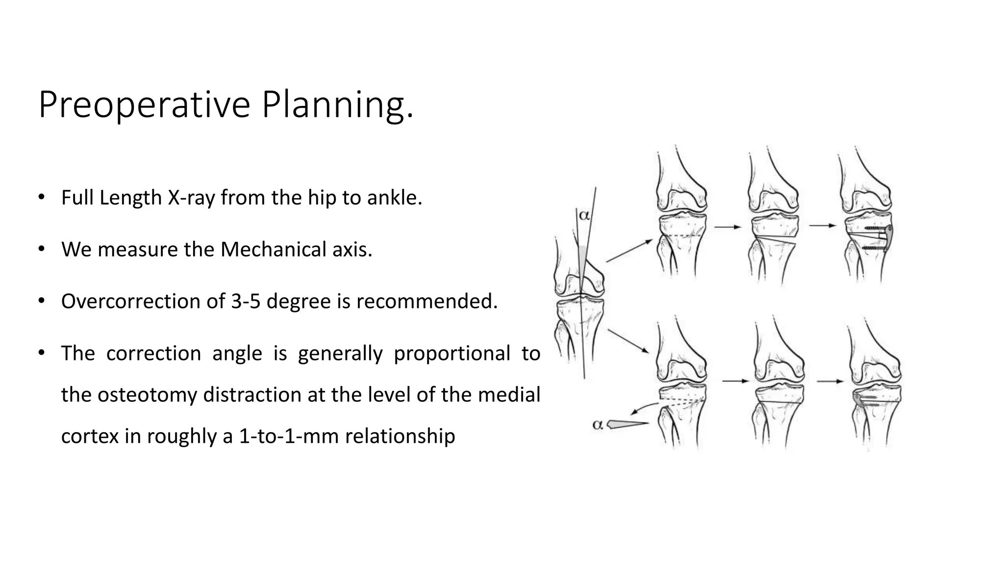 High Tibial Osteotomies | PPTX