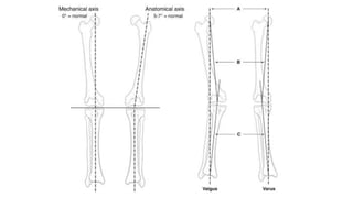 High Tibial Osteotomies | PPTX