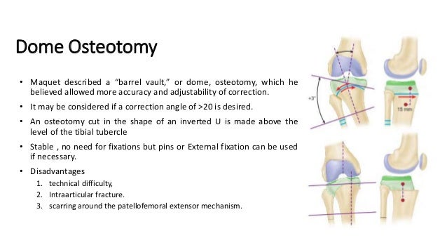 High Tibial Osteotomies