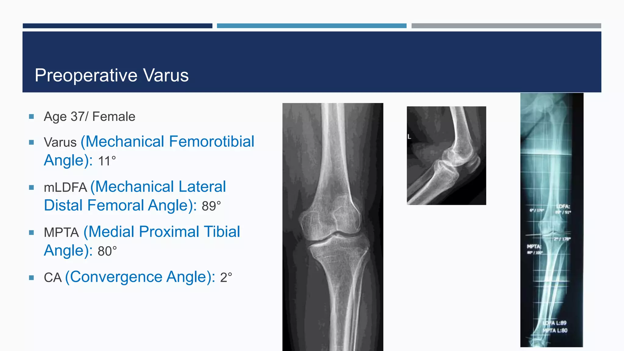 High tibial osteotomy- All you need to know | PPTX