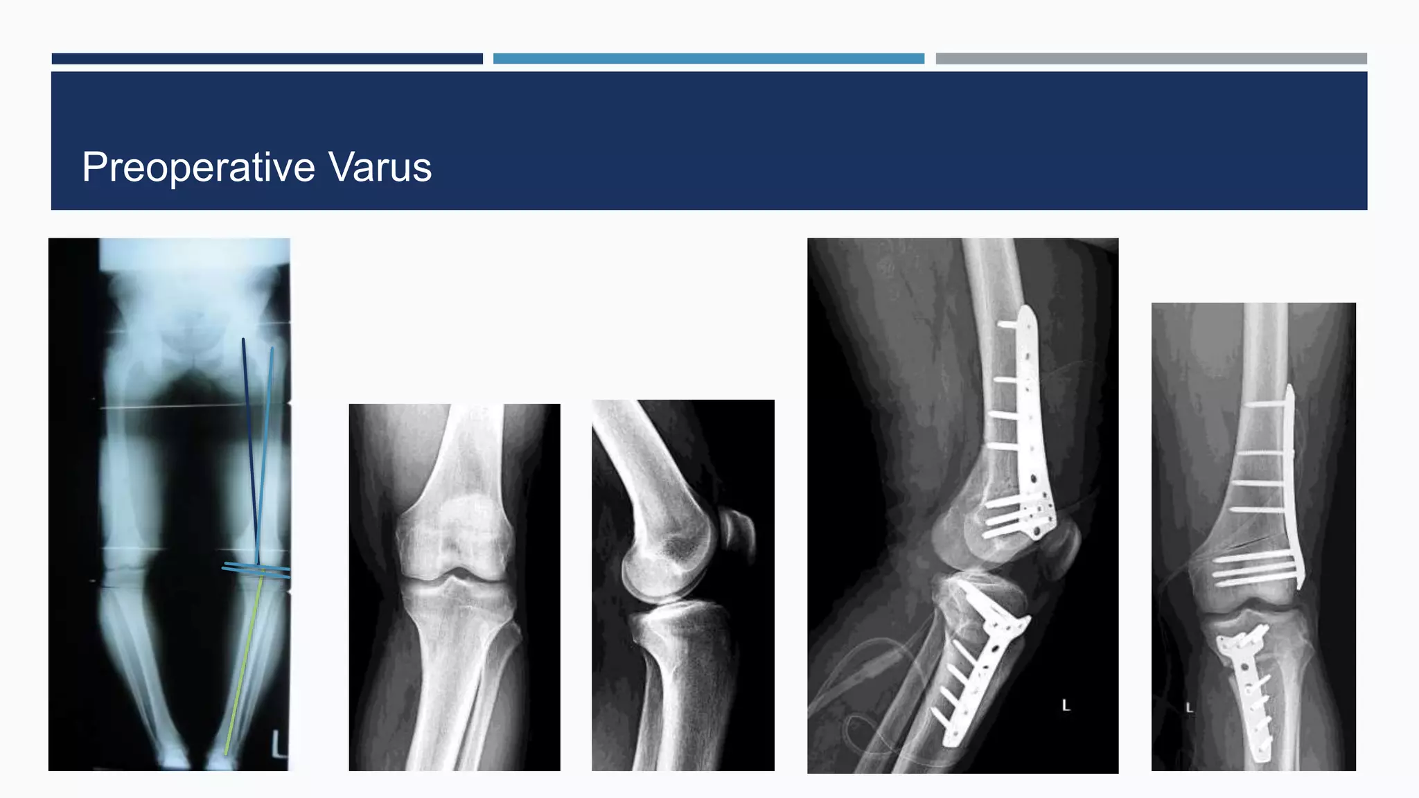 High tibial osteotomy- All you need to know | PPTX