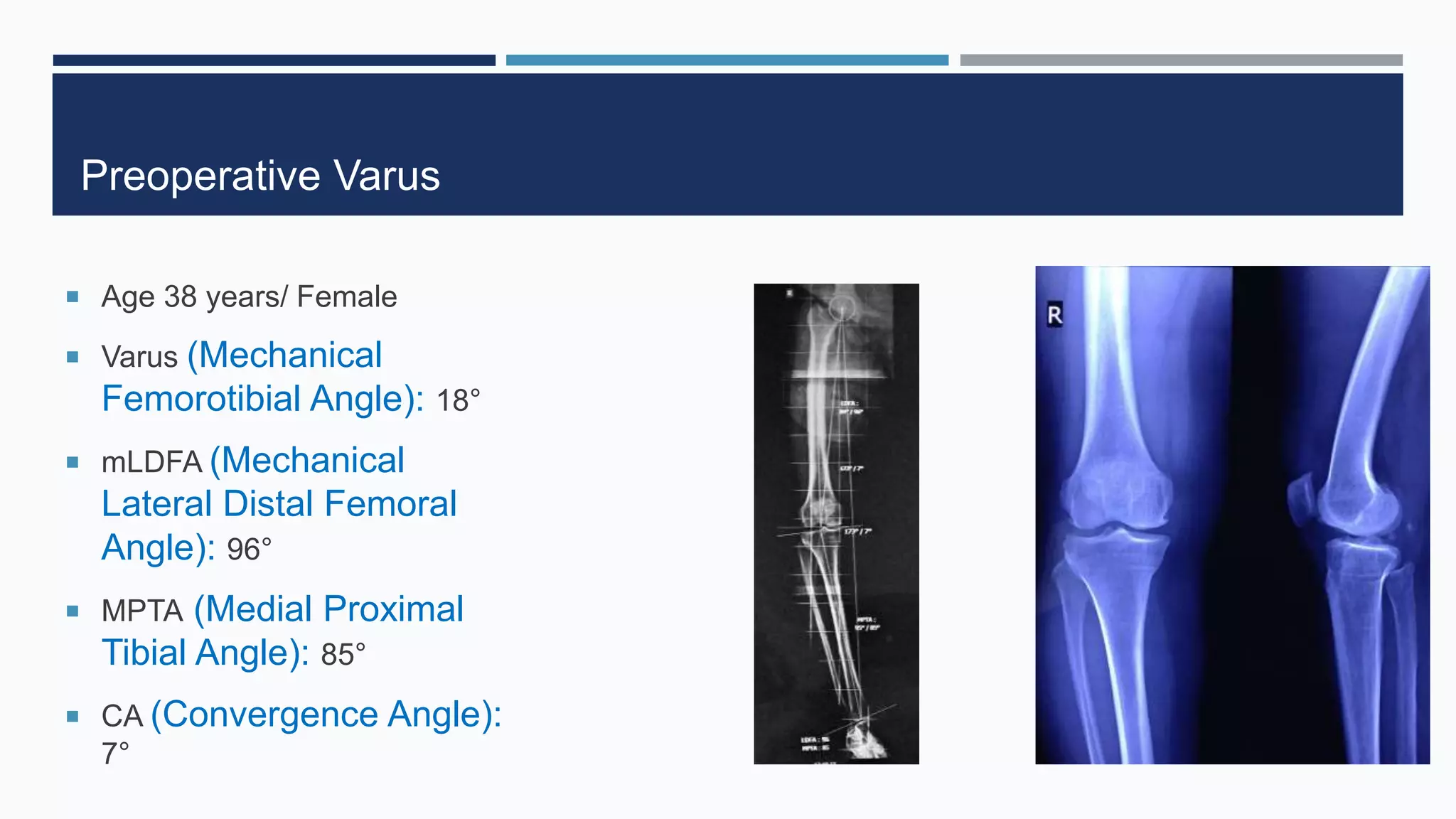 High tibial osteotomy- All you need to know | PPTX