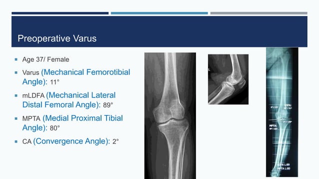 High tibial osteotomy- All you need to know | PPT
