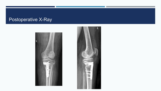 High tibial osteotomy- All you need to know | PPT