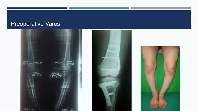 High tibial osteotomy- All you need to know | PPT