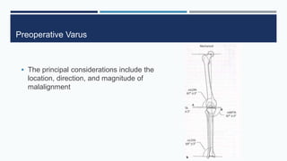 High tibial osteotomy- All you need to know | PPTX