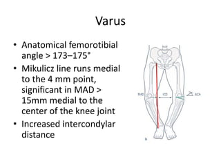 HIgh Tibial Osteotomy: when and how | PPTX