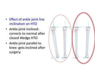 HIgh Tibial Osteotomy: when and how | PPTX