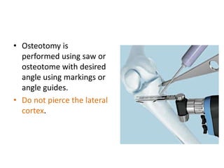 HIgh Tibial Osteotomy: when and how | PPTX