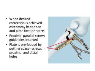 HIgh Tibial Osteotomy: when and how | PPTX