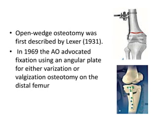 HIgh Tibial Osteotomy: when and how | PPTX