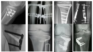 HTO high tibial osteotomy still a role.pptx