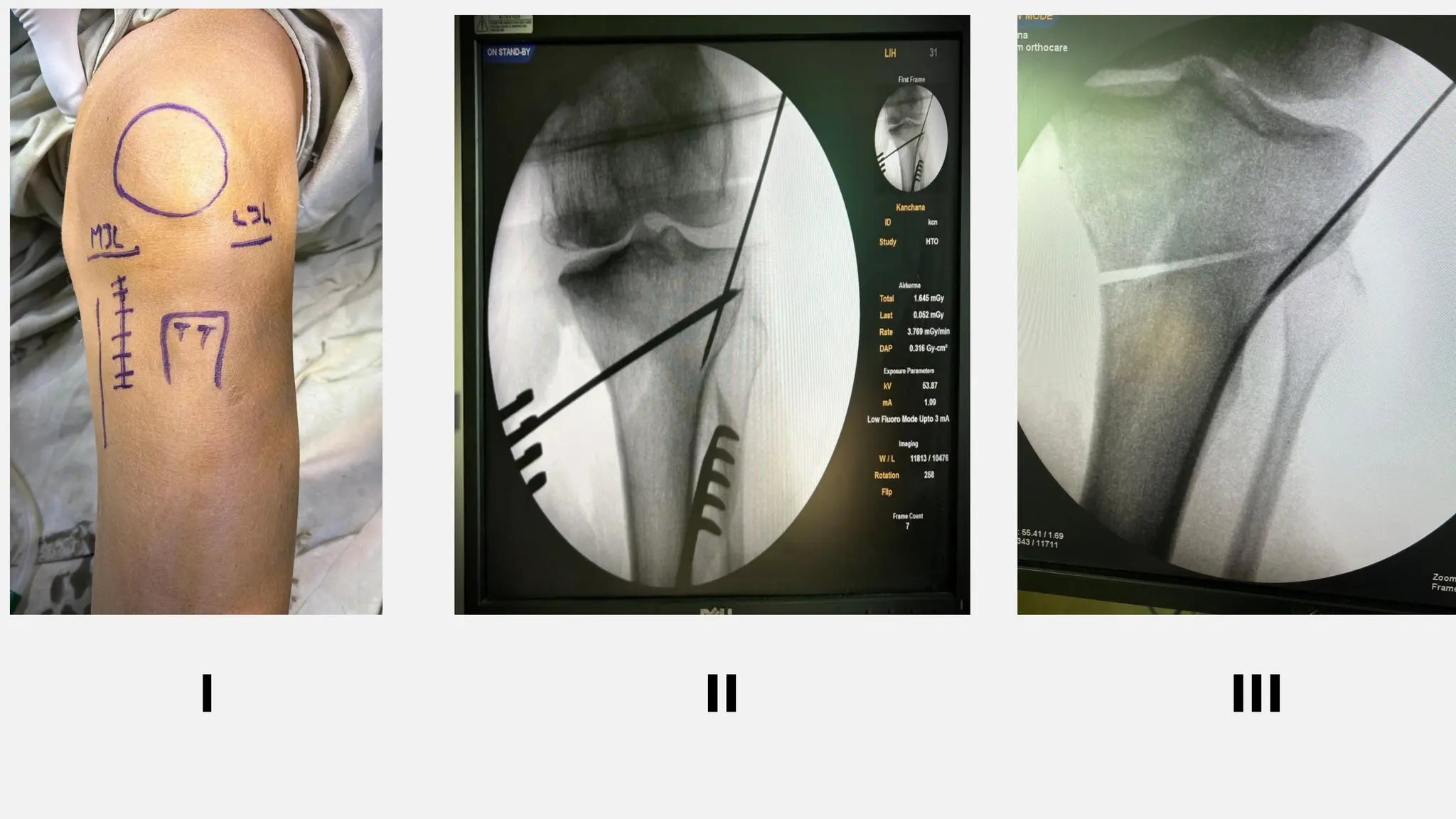 High Tibial Osteotomy is done for treating osteoarthritis confined to ...