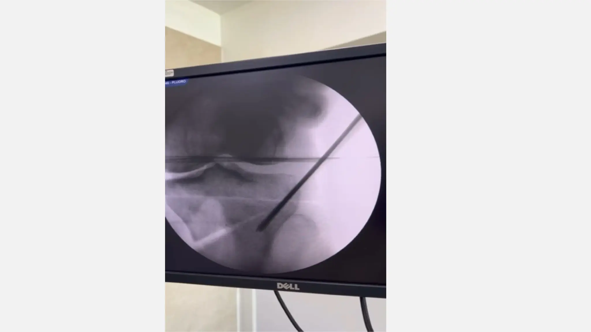 High Tibial Osteotomy is done for treating osteoarthritis confined to ...
