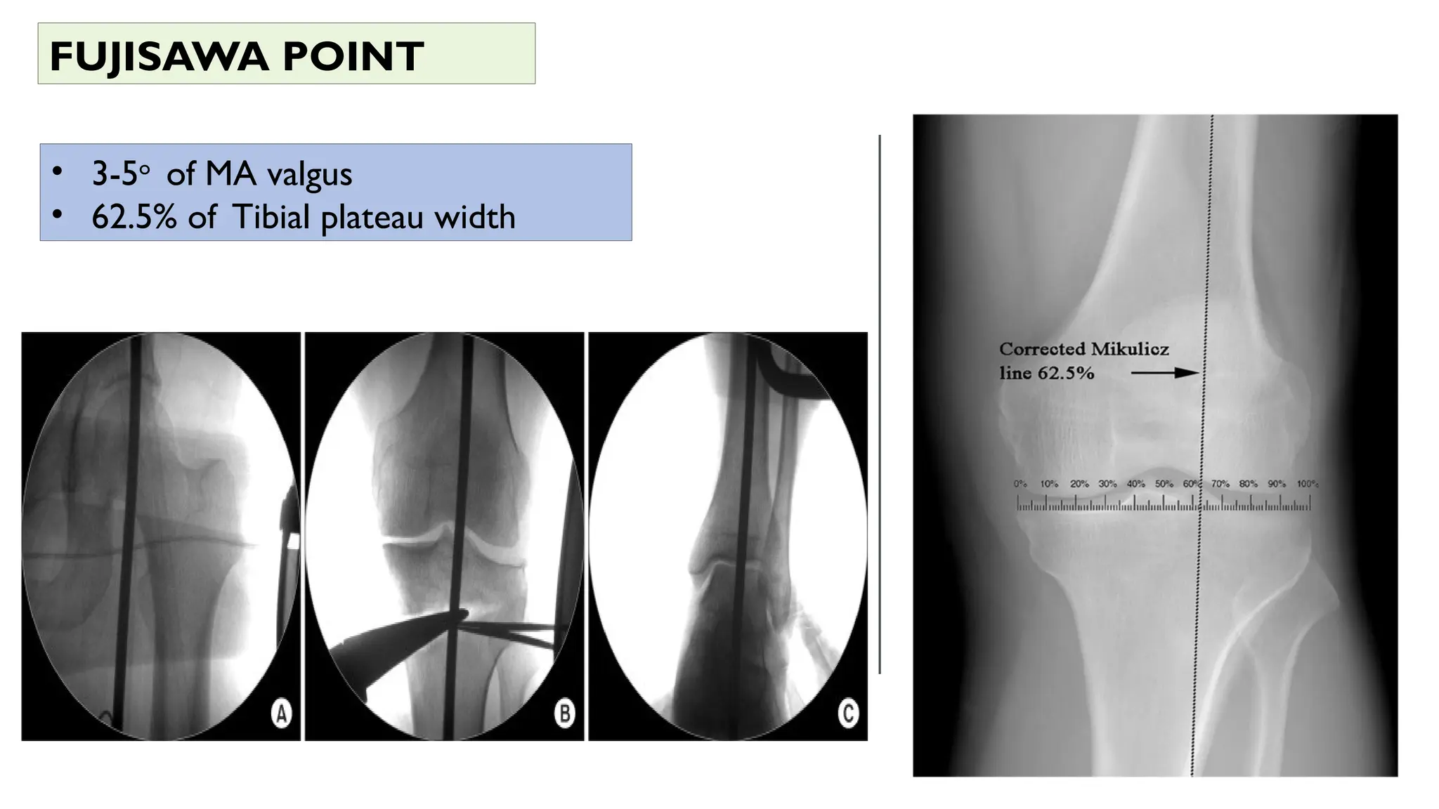 High Tibial Osteotomy is done for treating osteoarthritis confined to ...