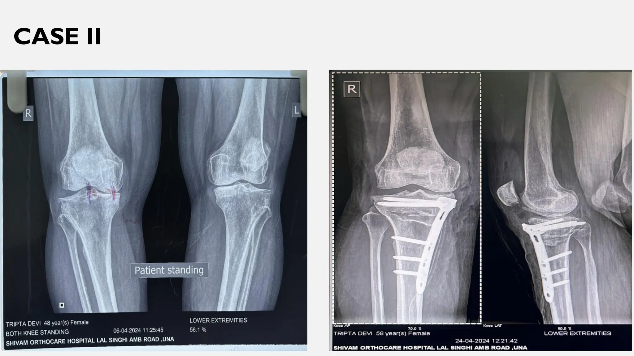 High Tibial Osteotomy is done for treating osteoarthritis confined to ...