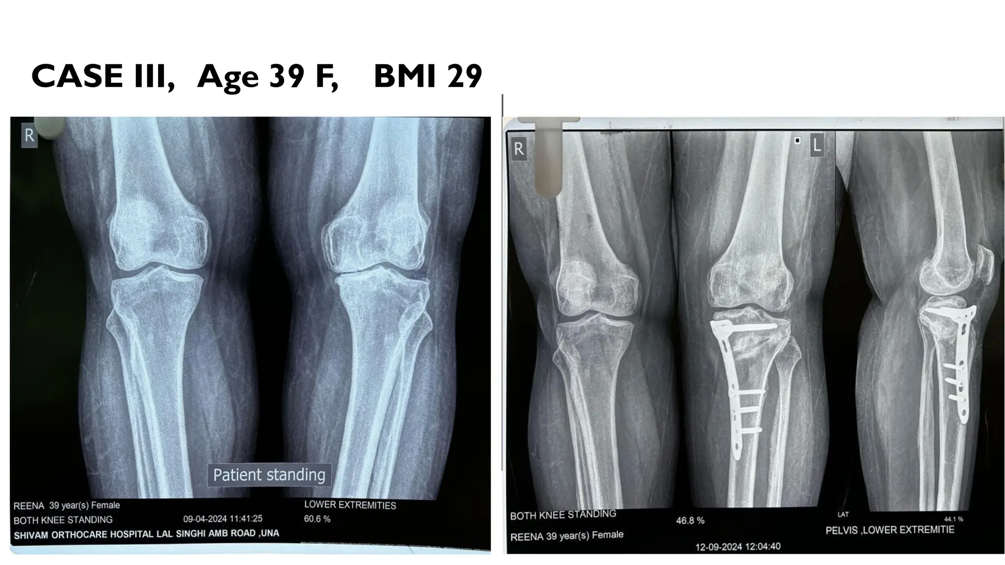 High Tibial Osteotomy is done for treating osteoarthritis confined to ...