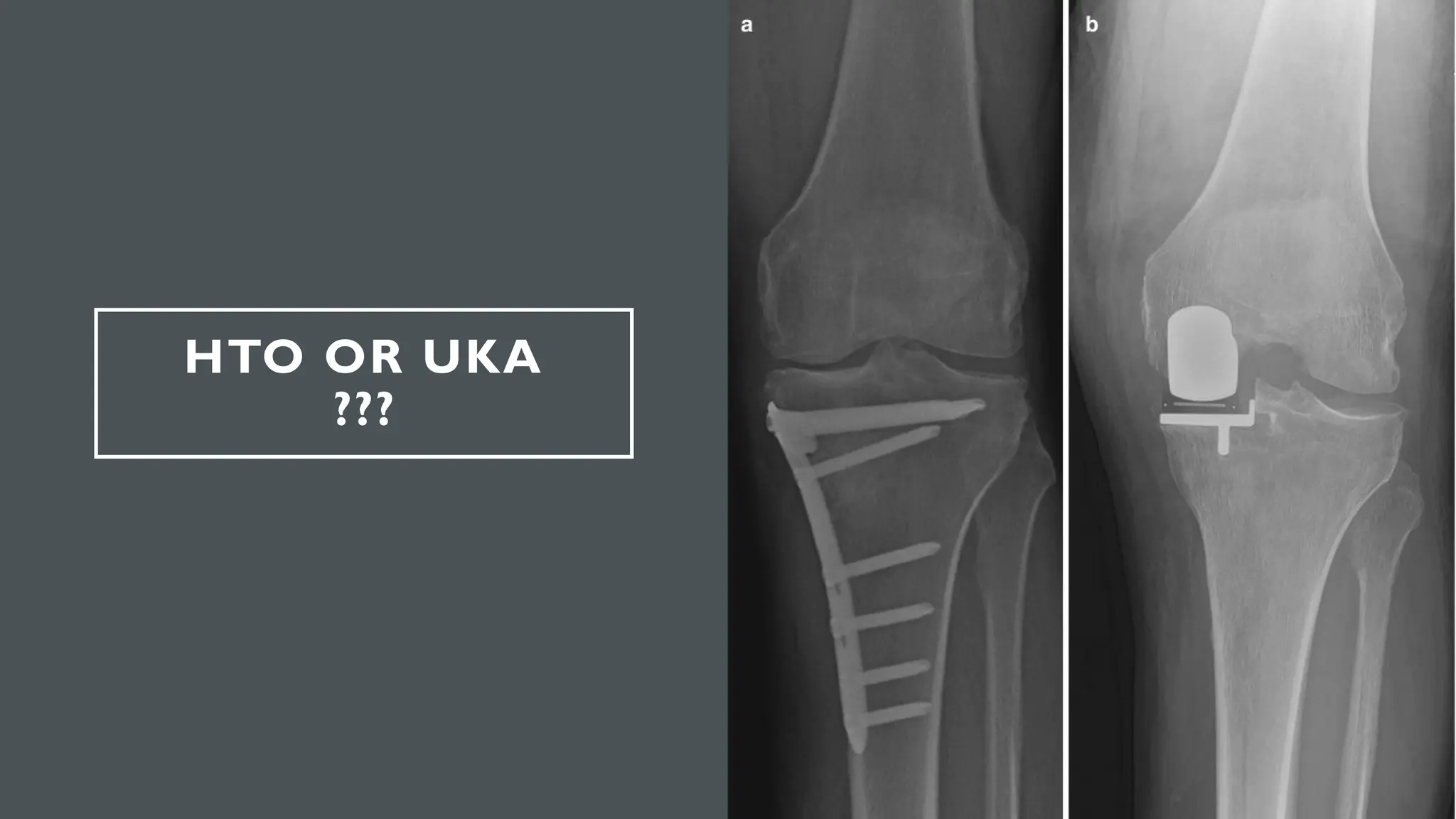 High Tibial Osteotomy is done for treating osteoarthritis confined to ...