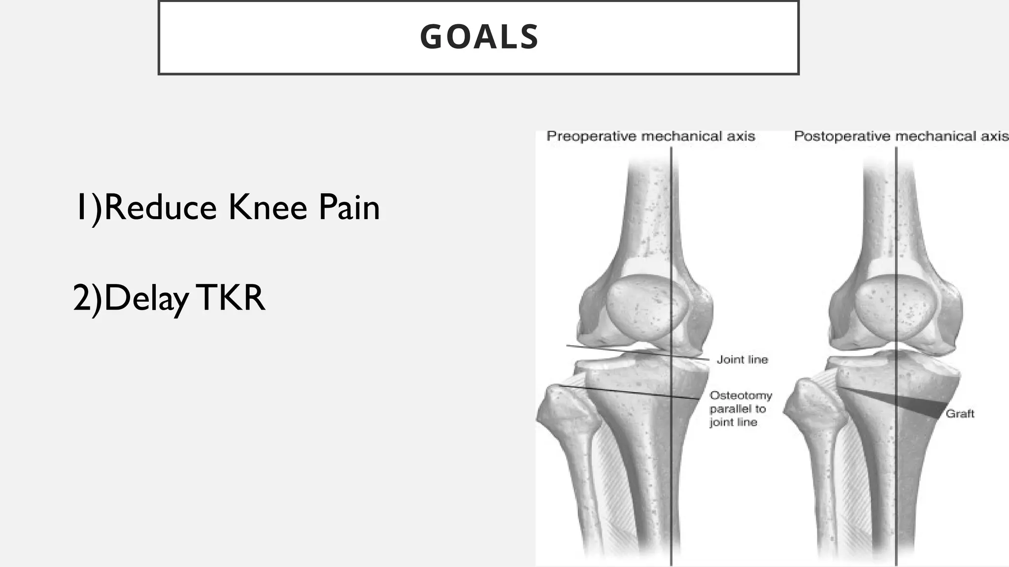 High Tibial Osteotomy is done for treating osteoarthritis confined to ...