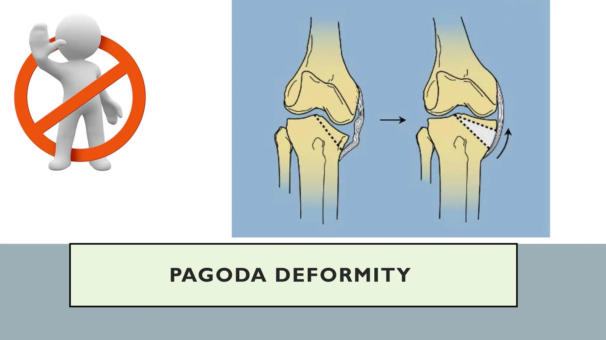 High Tibial Osteotomy is done for treating osteoarthritis confined to ...