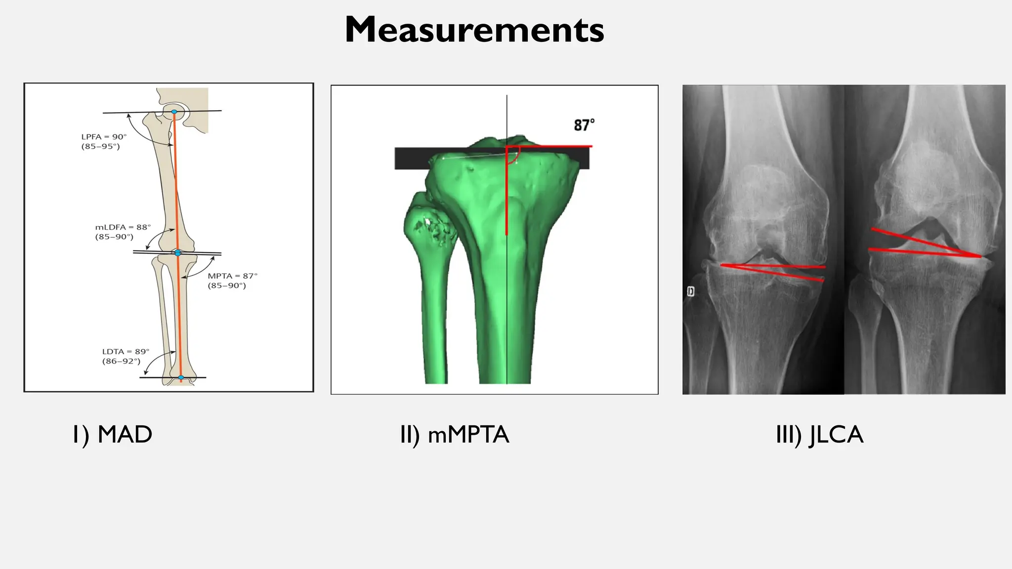 High Tibial Osteotomy is done for treating osteoarthritis confined to ...