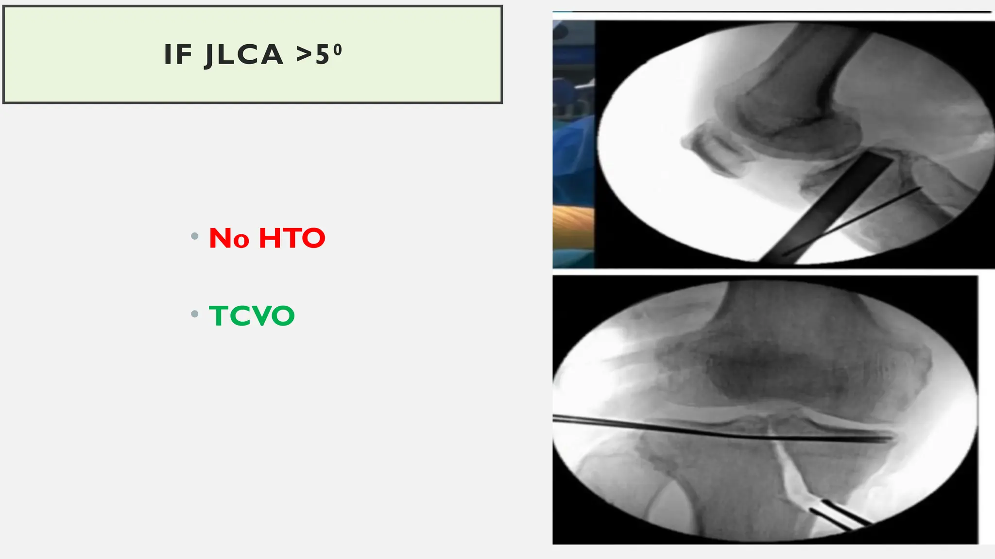 High Tibial Osteotomy is done for treating osteoarthritis confined to ...
