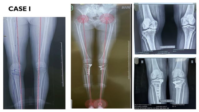 High Tibial Osteotomy is done for treating osteoarthritis confined to ...