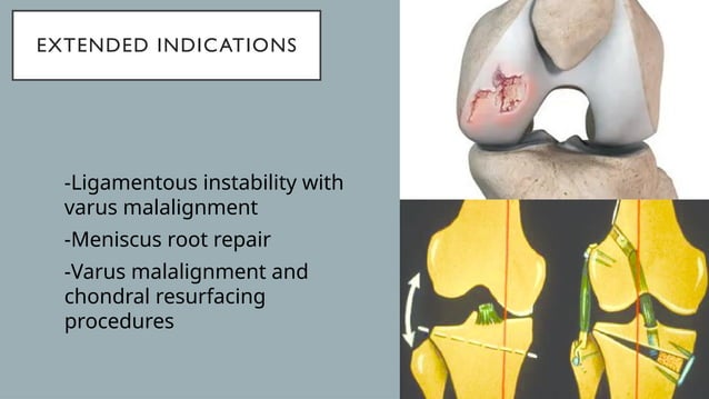 High Tibial Osteotomy is done for treating osteoarthritis confined to ...