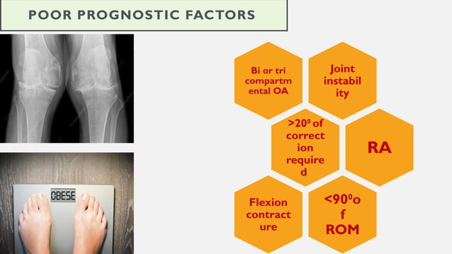High Tibial Osteotomy is done for treating osteoarthritis confined to ...